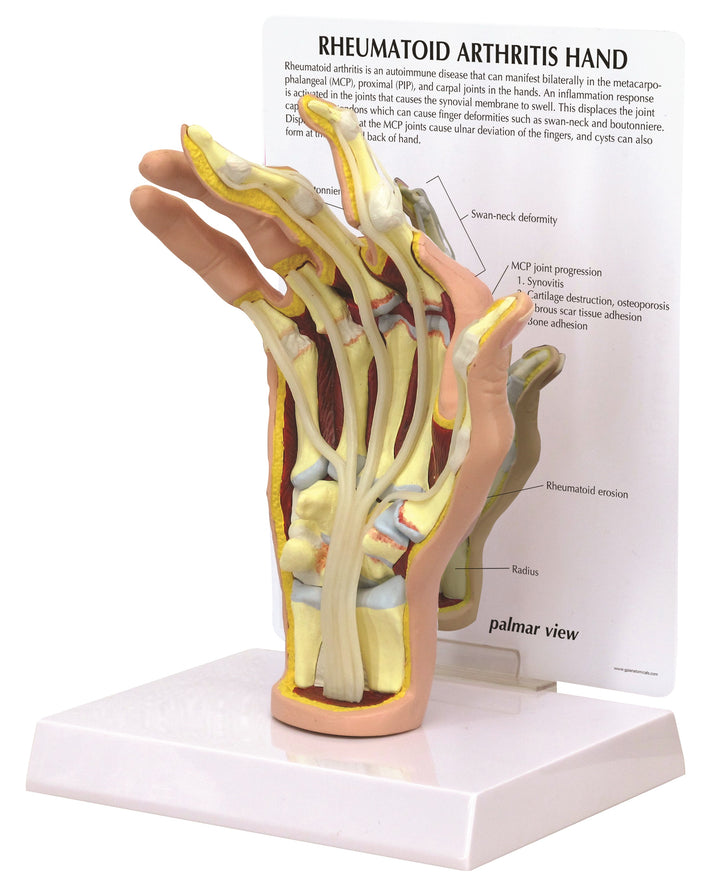 Model - Rheumatoid Arthritis (RA) Hand