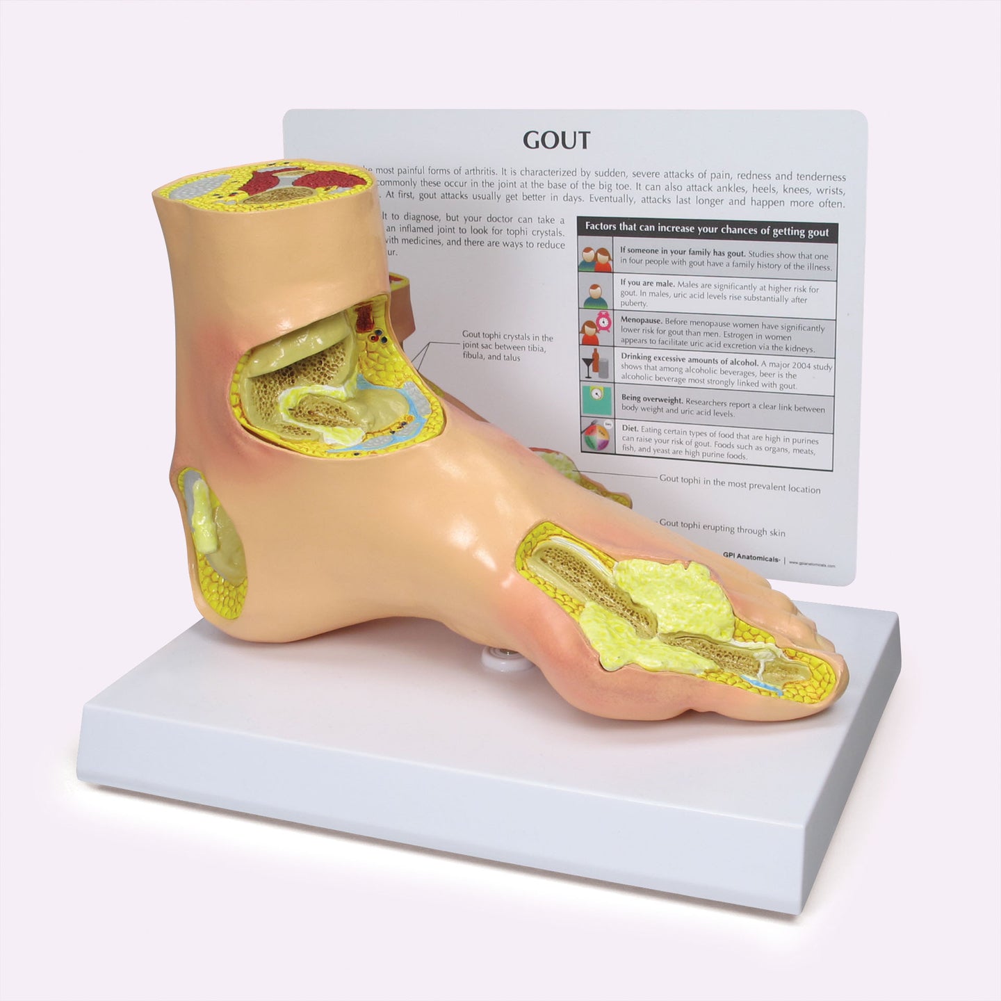 Model - Gout (Foot)