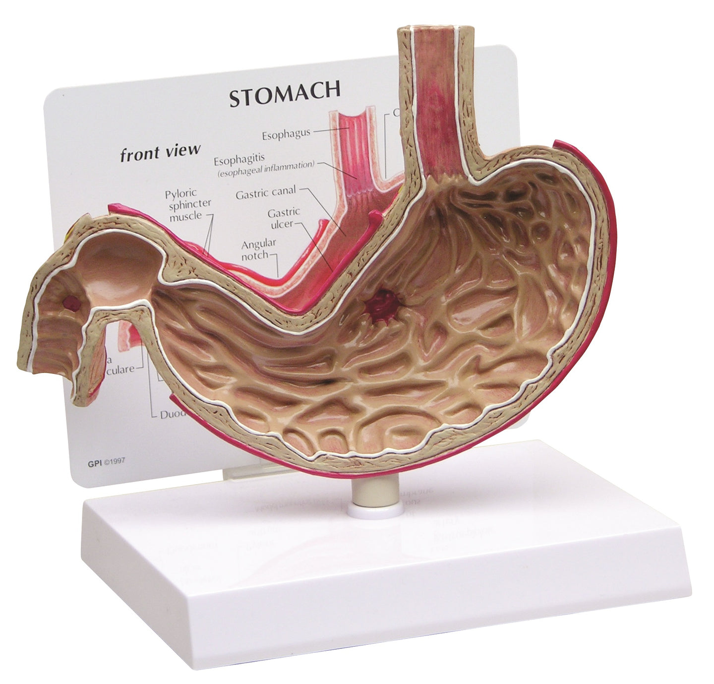 Model - Stomach (With Ulcers)