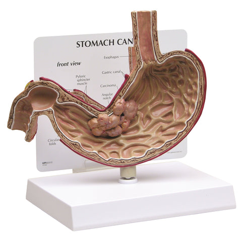 Model - Stomach Cancer