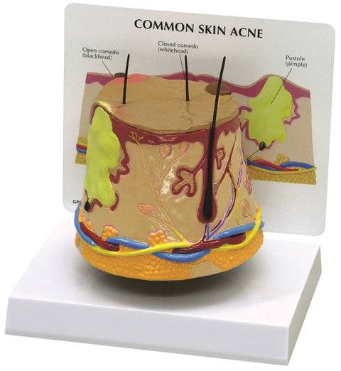 Model - Common Skin Acne