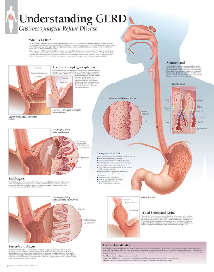 Chart - Understanding GERD