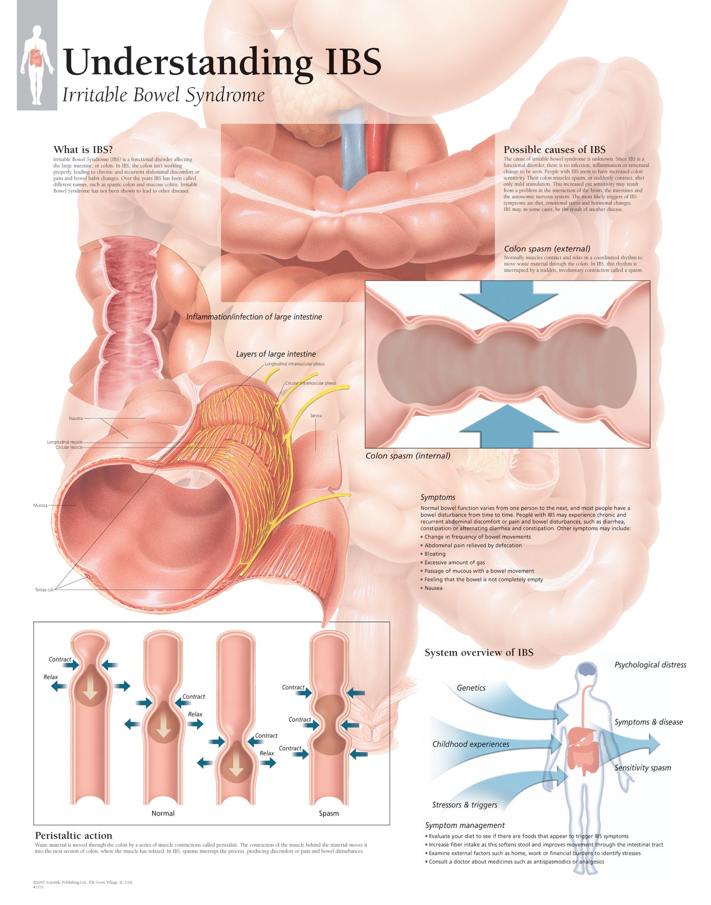 Chart - Understanding IBS