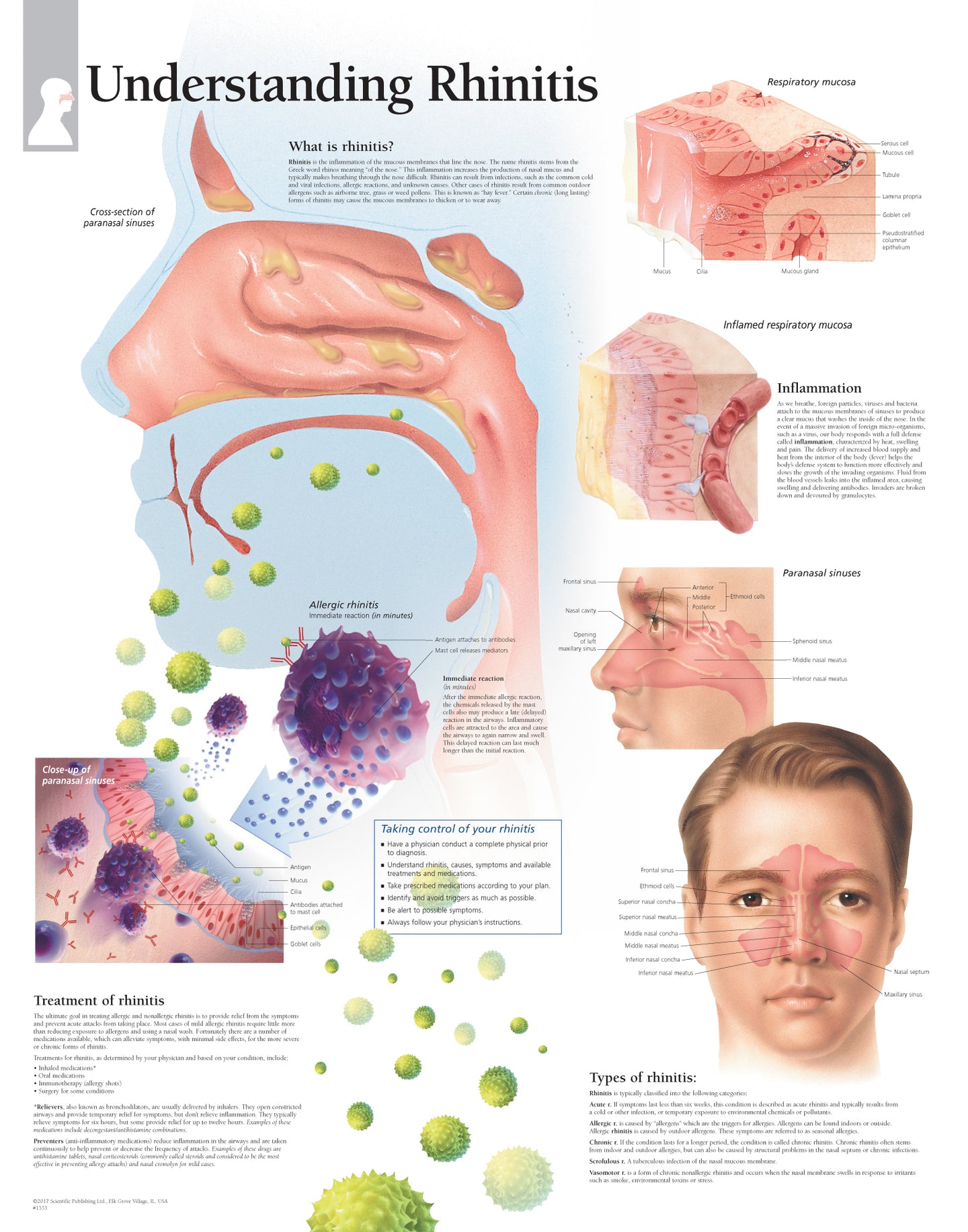 Chart - Understanding Rhinitis
