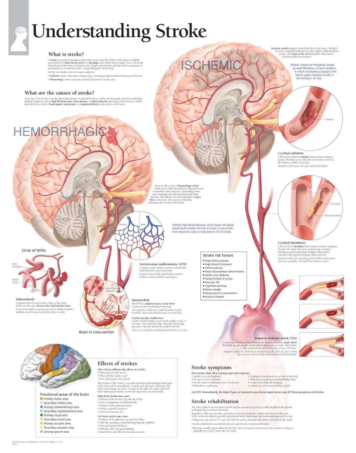 Chart - Understanding Stroke